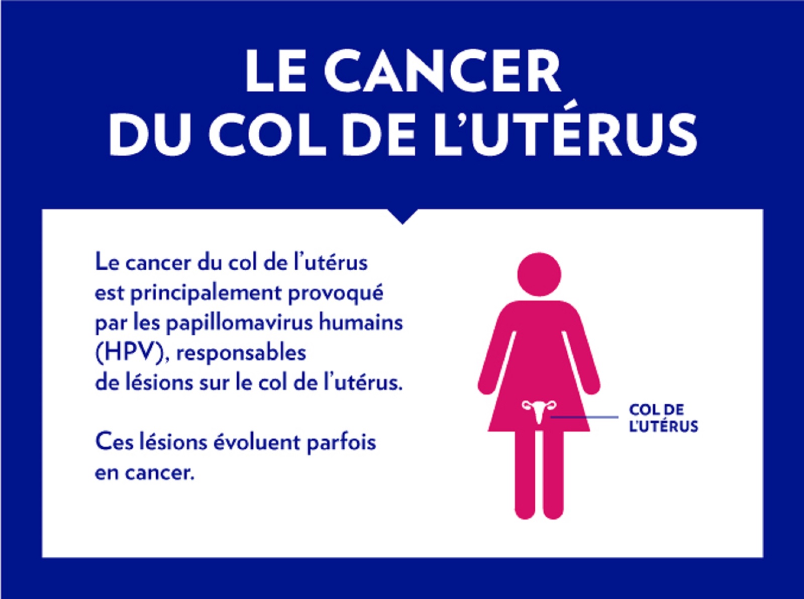 Grâce au frottis de dépistage, le cancer du col de l’utérus peut être ...